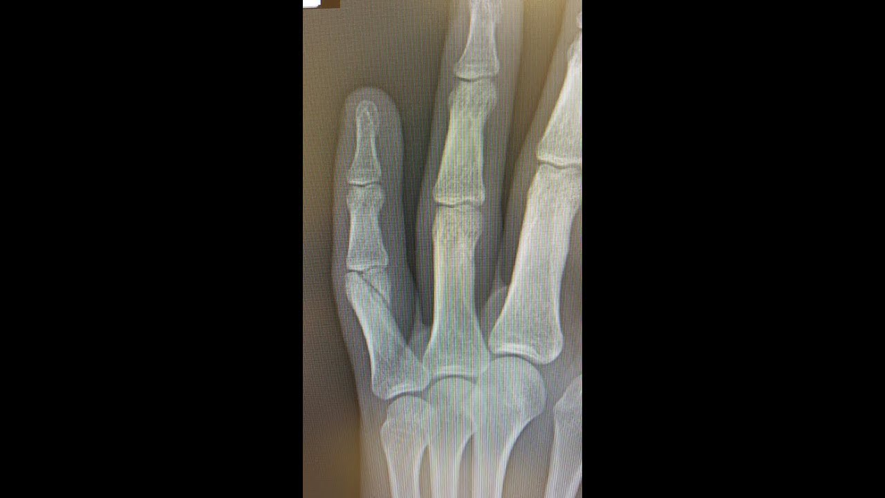 BROKE MY FINGER - YouTube