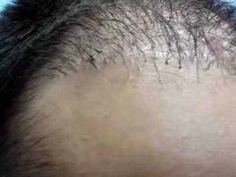 Bad fue hair transplant - YouTube