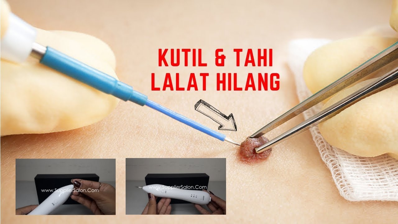 Ini dia alat untuk menghilangkan Kutil & Tahi Lalat | Alat Soft Cauter ...