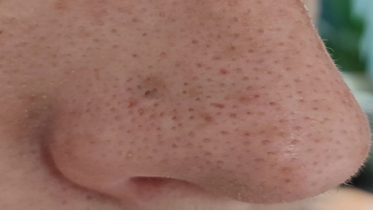 how to get rid of nose acne scars without products - YouTube