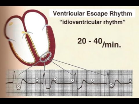 ECG part 8, Ventricular escape rhythm, Accelerated idioventricular ...
