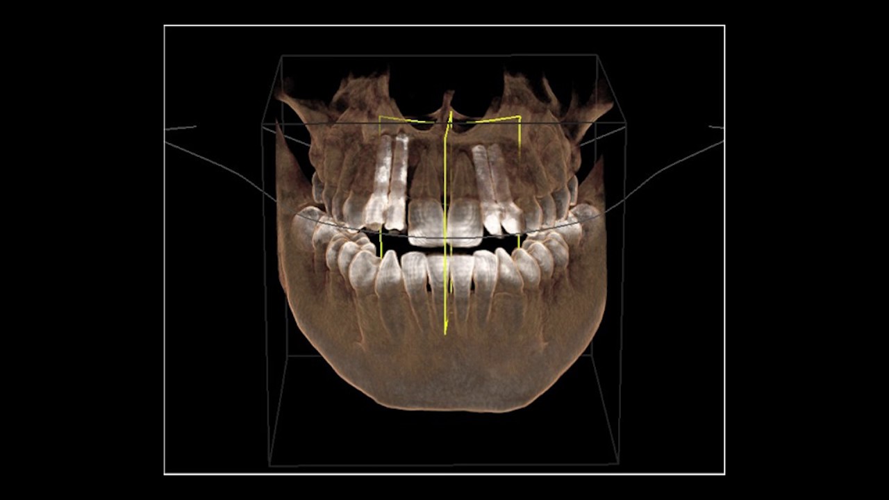 A new small diameter implant for a reduced surgical and prosthetic area. - YouTube