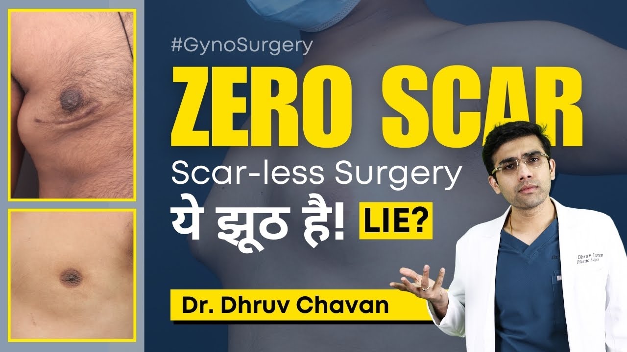Gyno Surgery के बाद कोई Scars नहीं? Scarless Gynecomastia surgery Scars ...