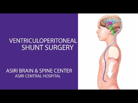 Ventriculoperitoneal Shunt Surgery - YouTube