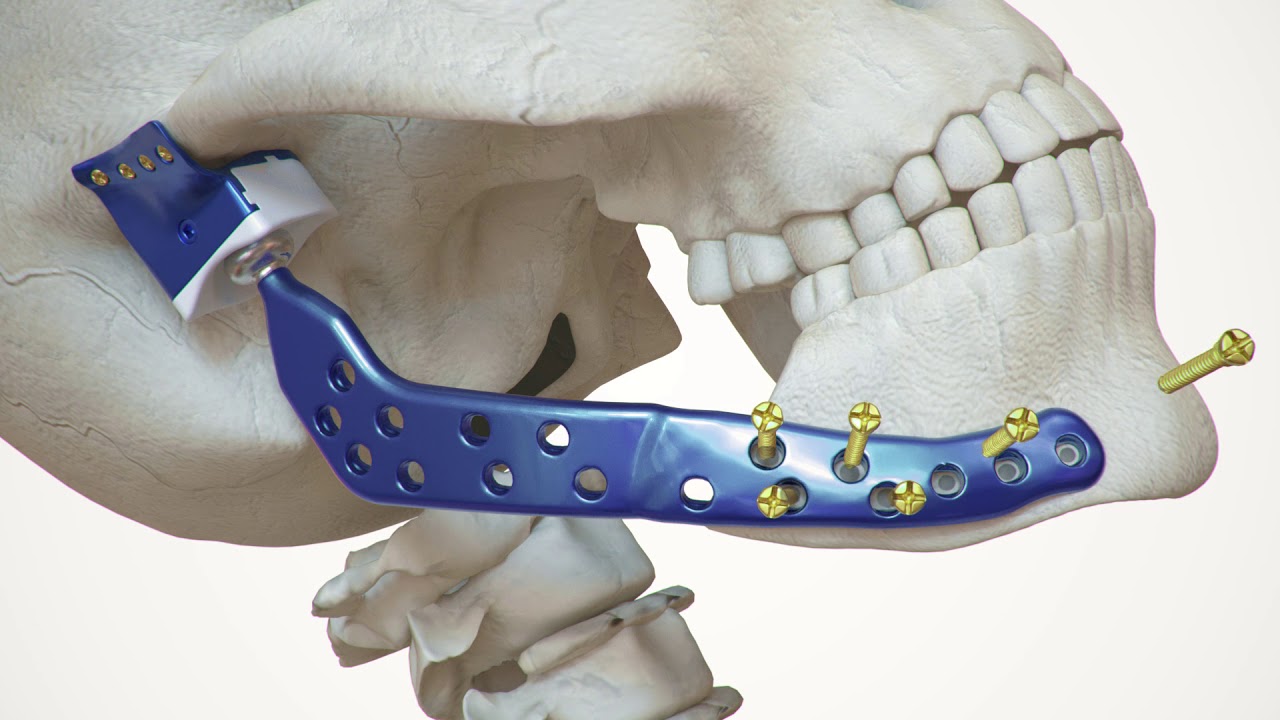 Prótese de ATM Customizada - Engimplan - YouTube