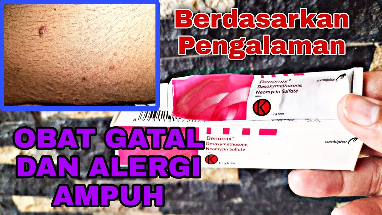 🔥Pengalaman Mengobati Gatal Alergi , Obat Gatal Kulit Denomix ...