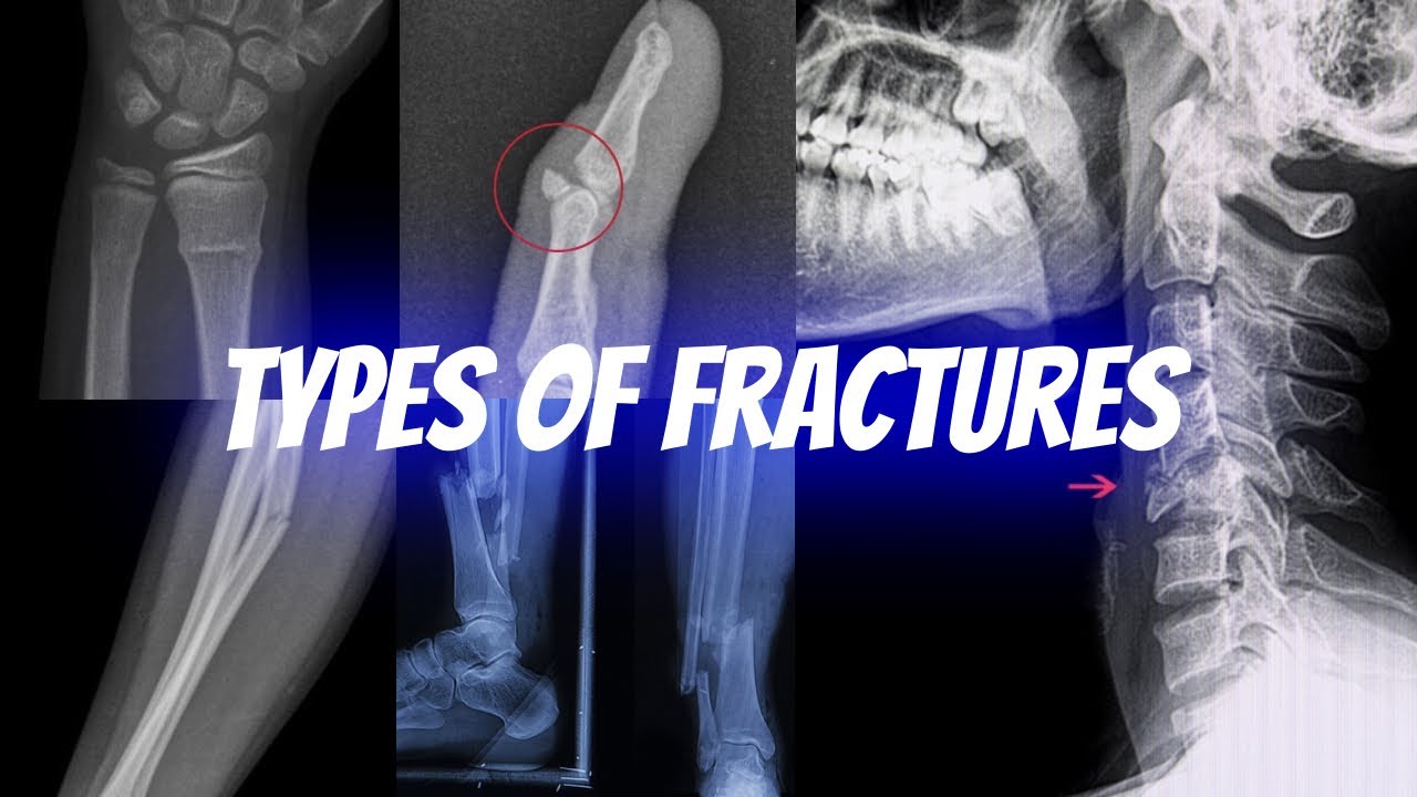 Types of Fractures - YouTube