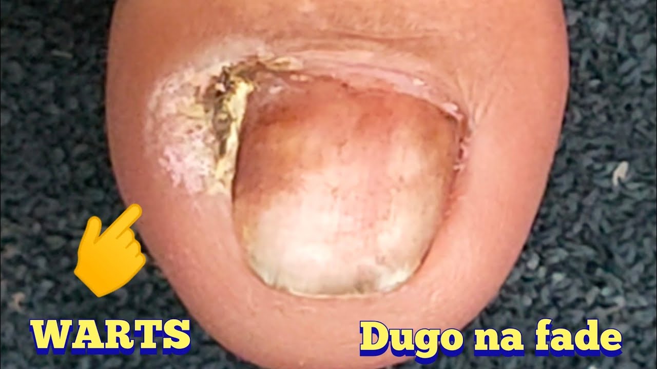 CUTTING OUT A FOOT WART | KALUNGGO HIDING UNDER A TOENAIL - YouTube