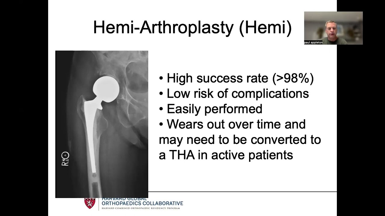 Bipolar Hemiarthroplasty Vs Total Hip Replacement