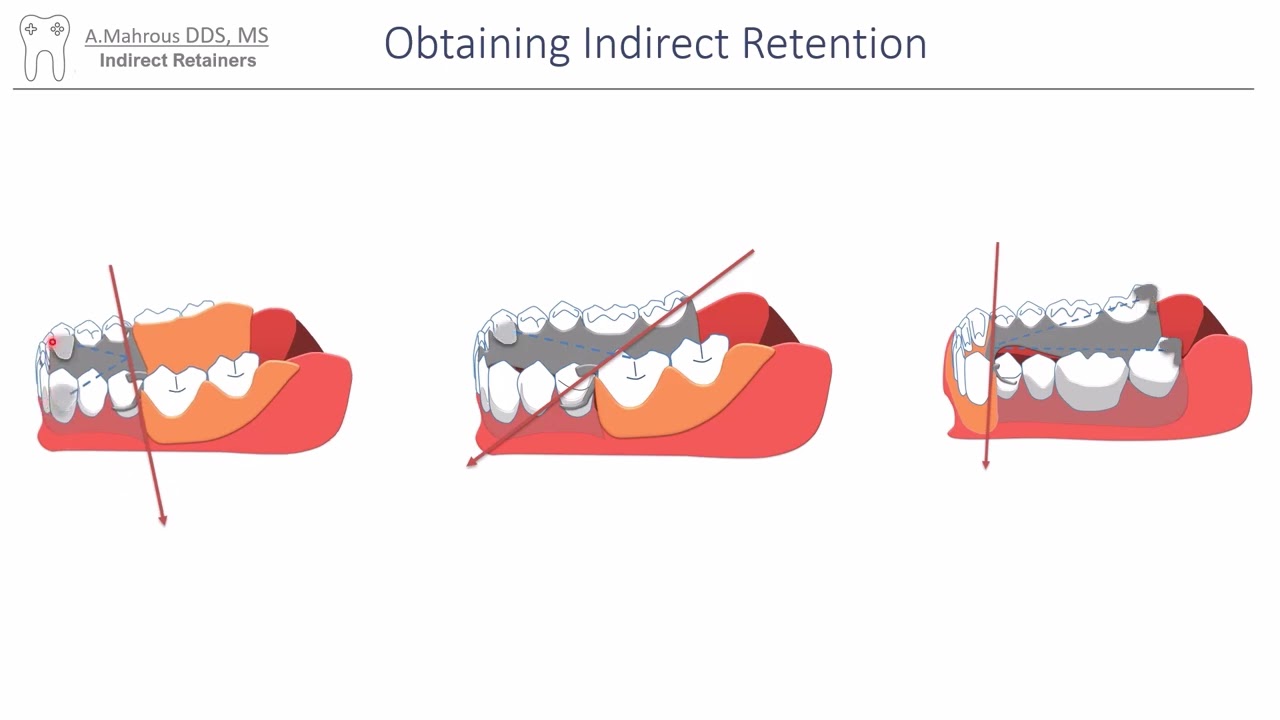 RPD Indirect Retainers in 2 mins - YouTube