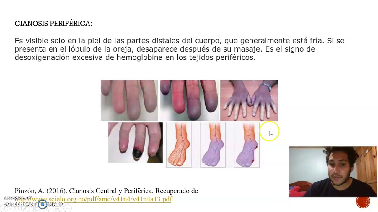 CIANOSIS - DEFINICIÓN, FISIOPATOLOGÍA, SEMIOLOGÍA - YouTube