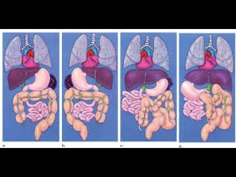 Dextrocardia vs dextroposition vs Situs inversus vs  Situs Ambiguous