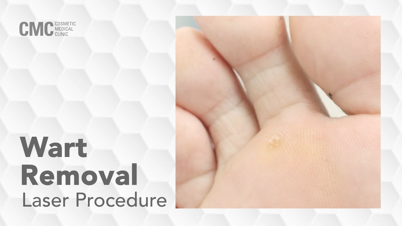 Laser Wart Removal | Cosmetic Medical Clinic CMC NSW - YouTube