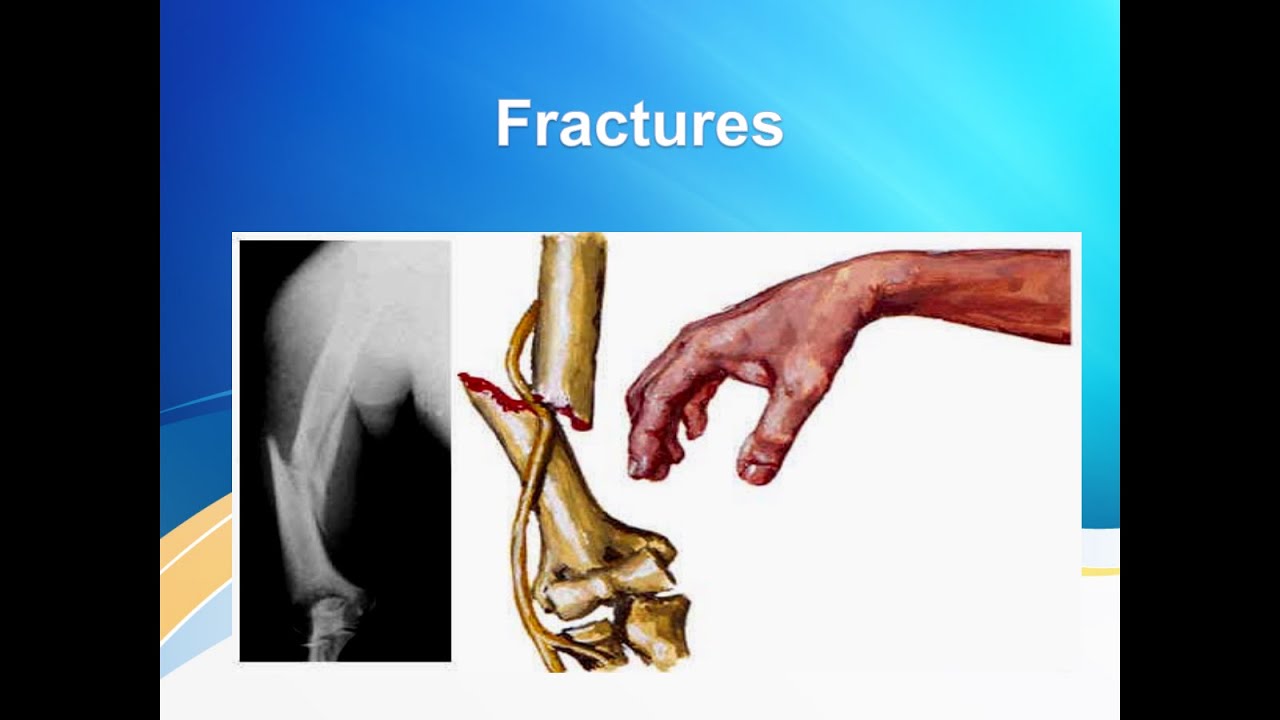 Fractures: classification and clinical features - YouTube