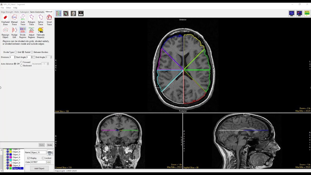 Analyze 14.0 - Segment: Divide Regions into Radial Sections - YouTube