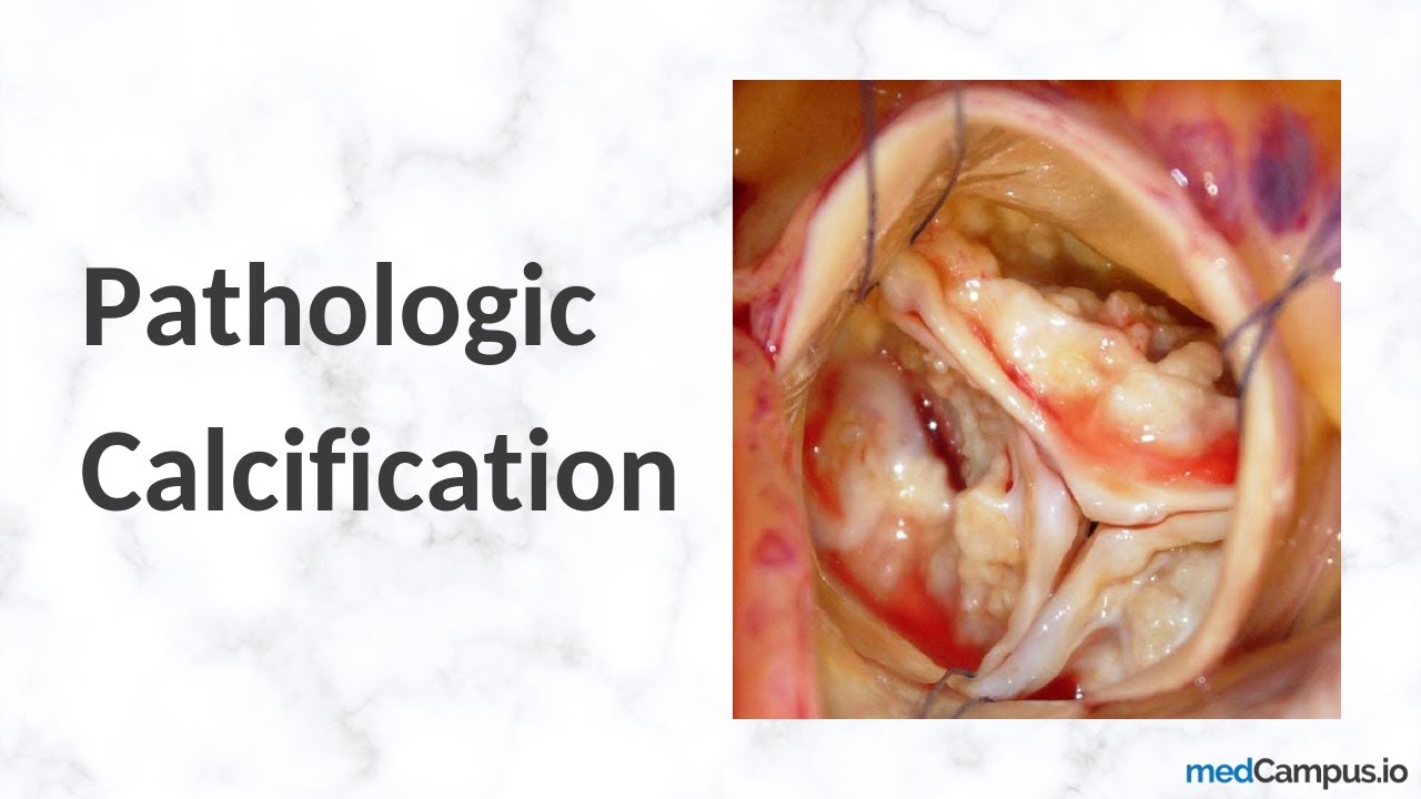 Metastatic vs Dystrophic Calcification | Pathology | High YIeld - YouTube