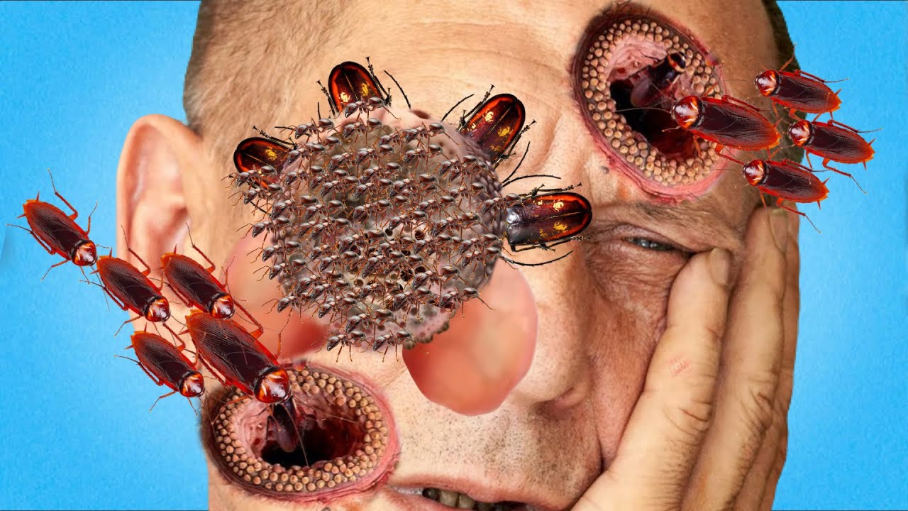 ASMR Maggots and Ticks Removal infection Eye man | Treatment removal ...