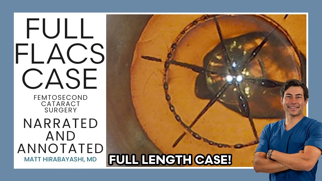 Full Femtosecond Laser Cataract Surgery Case (Narrated) - YouTube