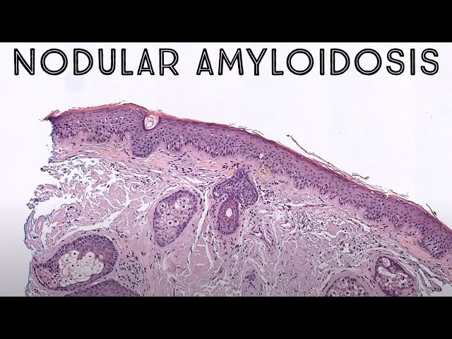 Lichen Amyloidosis Histopathology