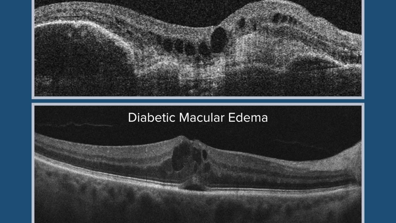 Choroidal Neovascularization (CNV) vs. Diabetic Macular Edema (DME ...