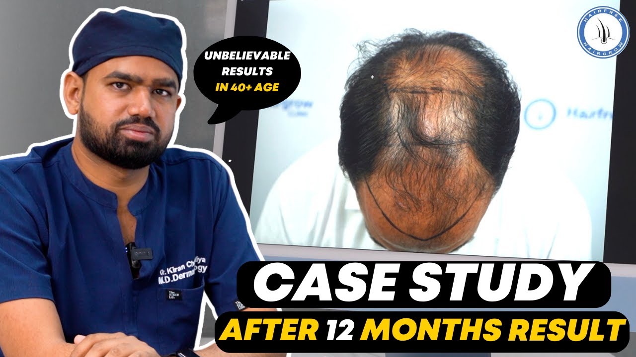 1-YEAR Hair Transplant Case Study | Shedding Phase | What are the Side Effects of PRP? - YouTube