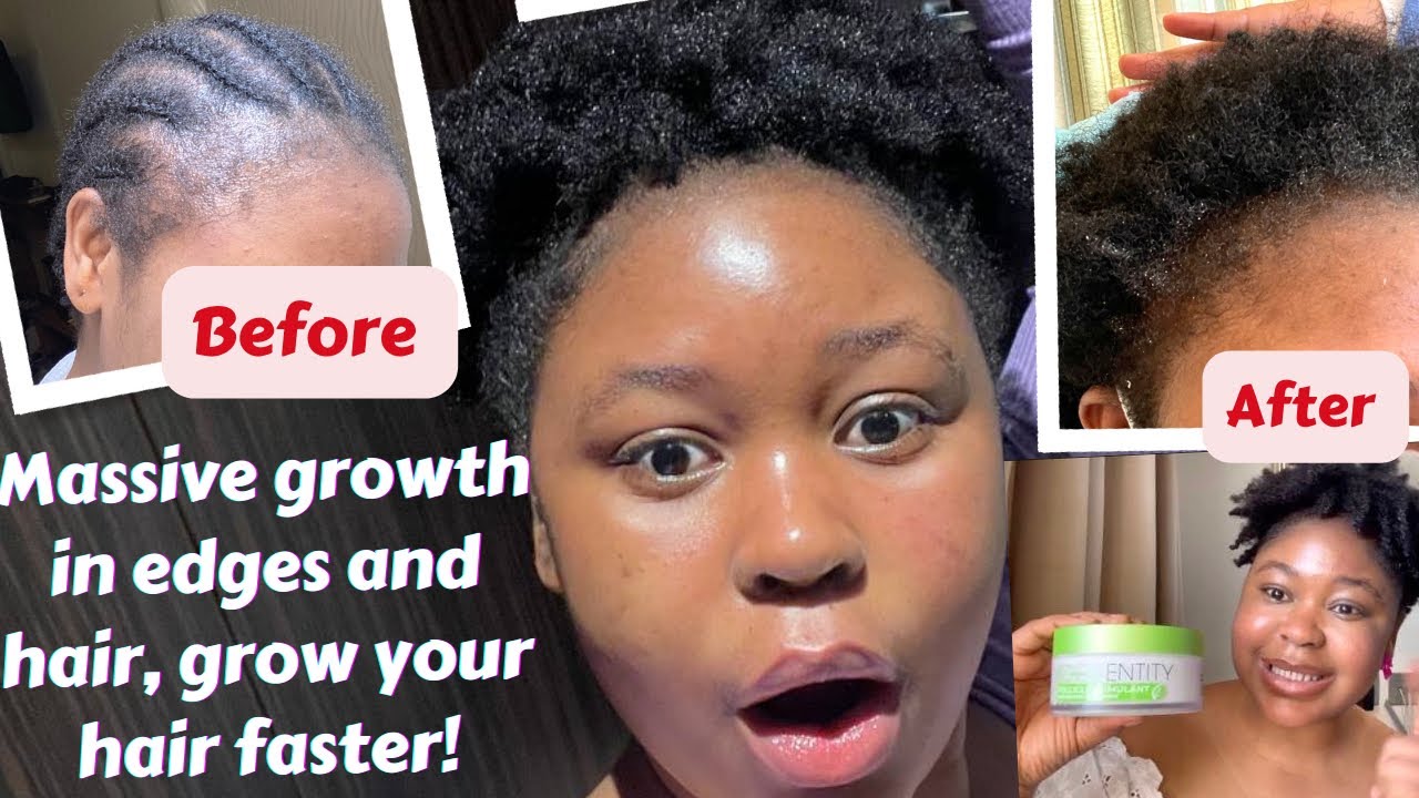 How to grow your edges faster| How to treat Aloepecia quickly| Hair ...