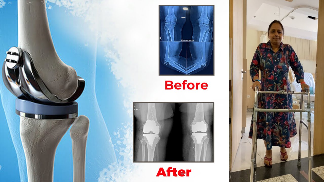 Patient Shares Her Experience After a Total Knee Replacement Surgery ...