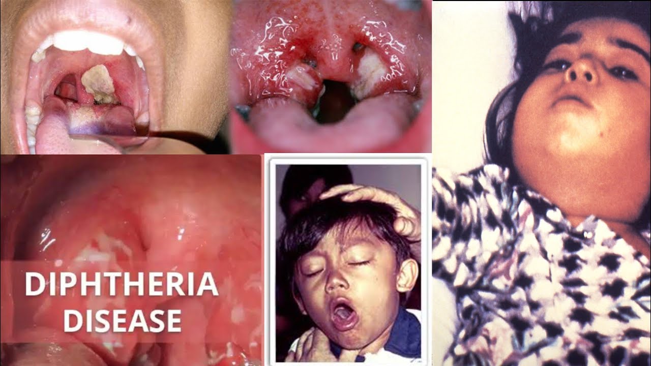 CUTAR MASHAKO ( DIPHTHERIA ) #youtuber #youtubeislife #newvideo # ...