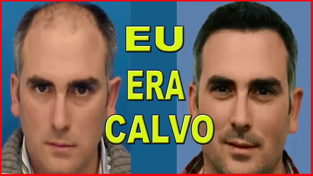 Veja como Recuperar seus Cabelos e deixar de ser Calvo ! - YouTube