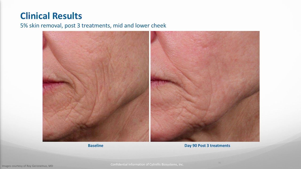Cytrellis Biosystems | Karen Cronholm, President & CEO - YouTube