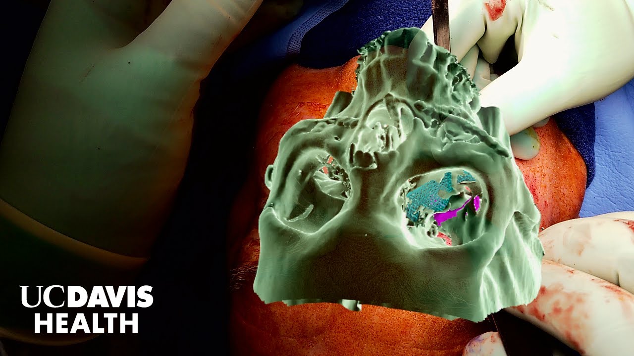 Mixed Reality Goggles Guide Complex Surgeries | UC Davis Health ...
