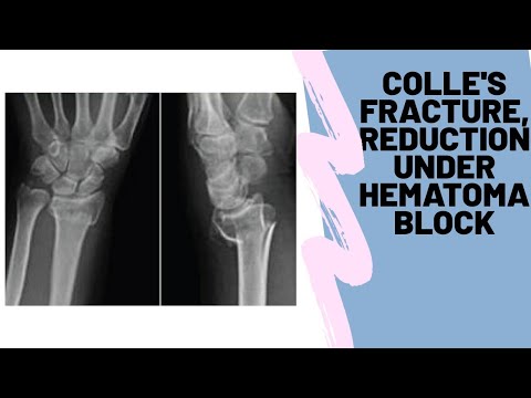 Distal radius colles' fracture reduction and plaster application under ...