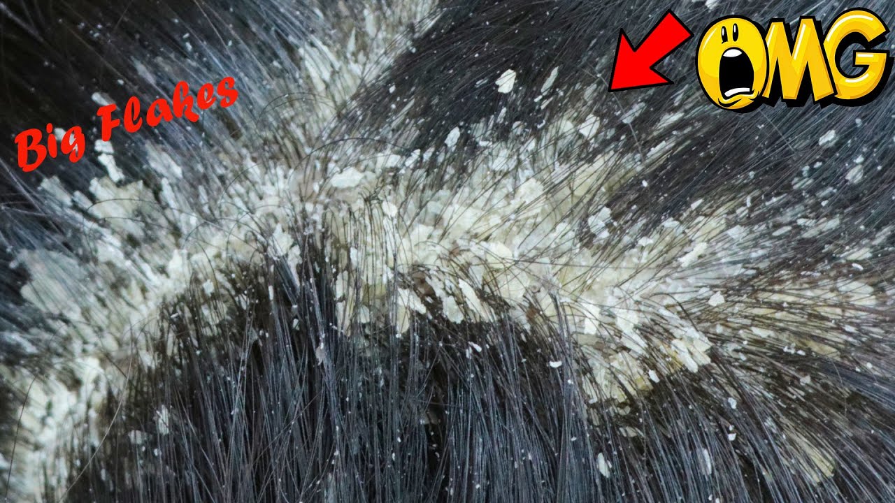 Dandruff Flakes Scratching and Picking Satisfying # 785 - YouTube