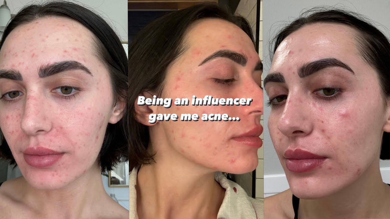 Being an influencer gave me acne… here’s how 😕 - YouTube