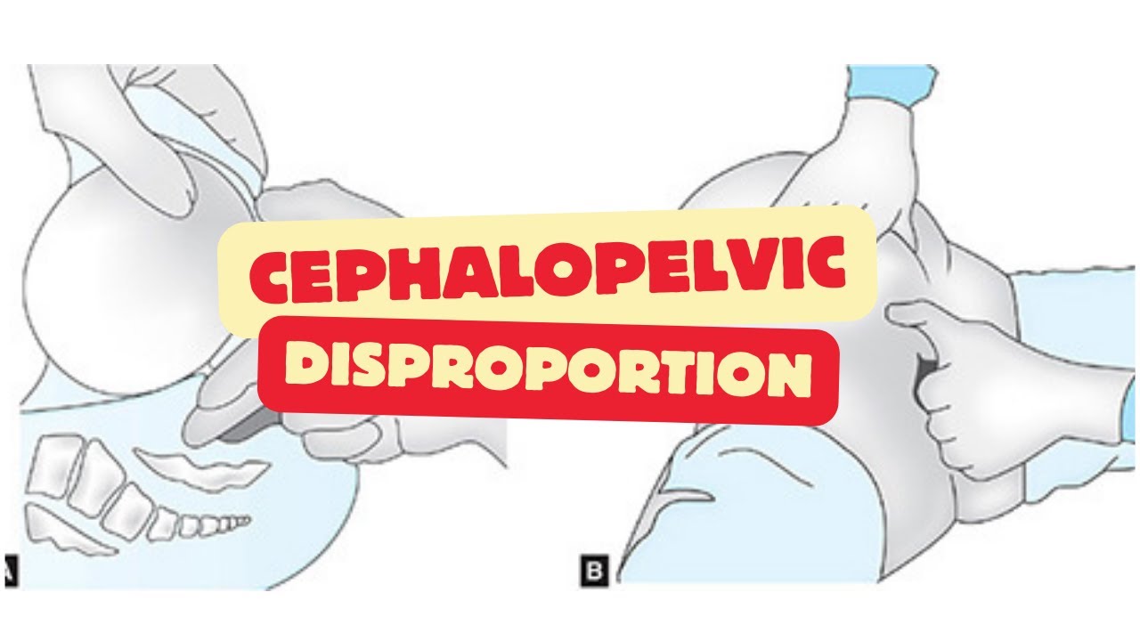Unmanned OSCE OBGYN | Cephalopelvic Disproportion & Uterine Rupture | TutorMed - YouTube