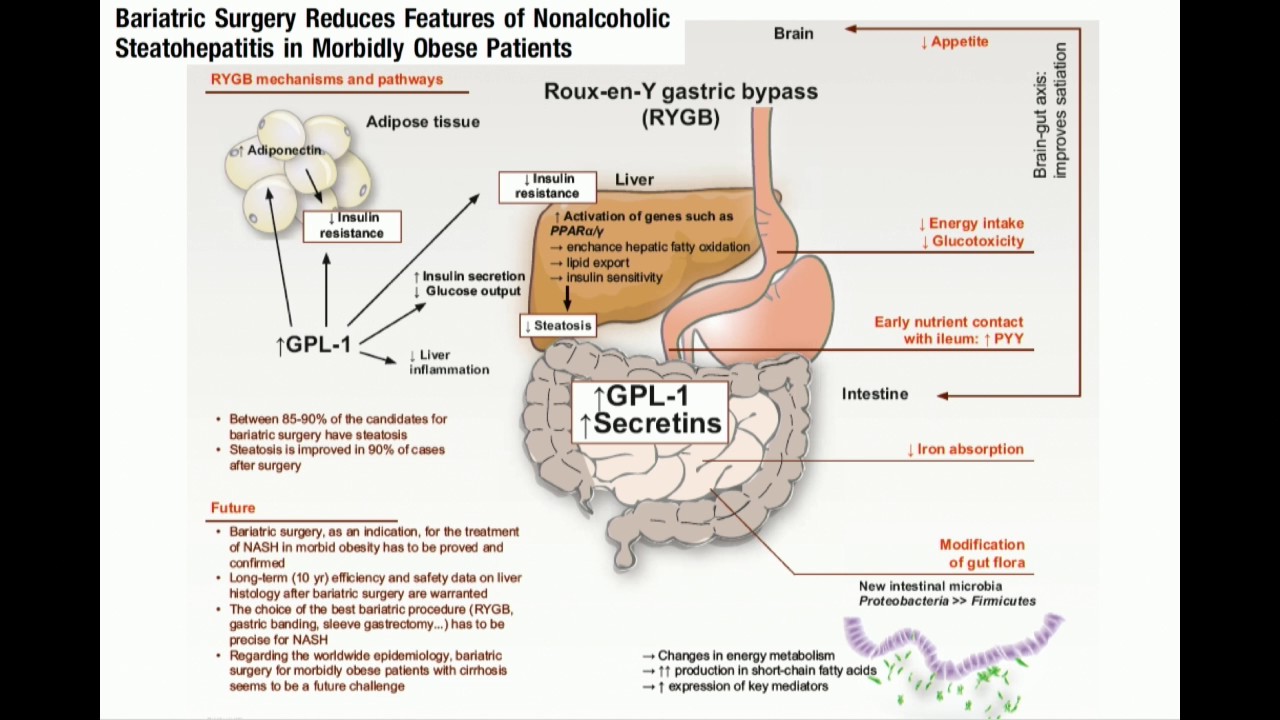 Steato hépatite non alcoolique et chirurgie bariatrique - YouTube