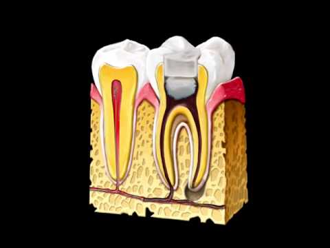Root Canal Treatment, Molar 3D Animation - YouTube