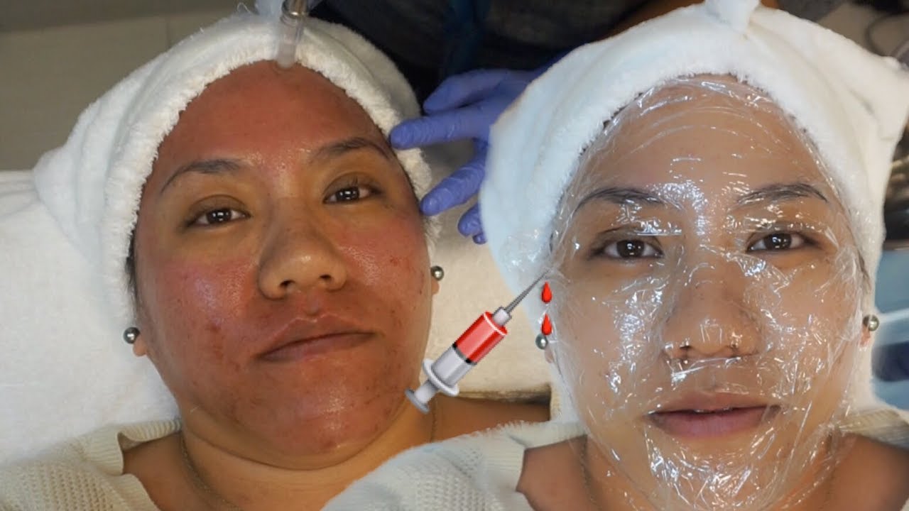 My First Chemical Peel & Microneedling Experience - YouTube