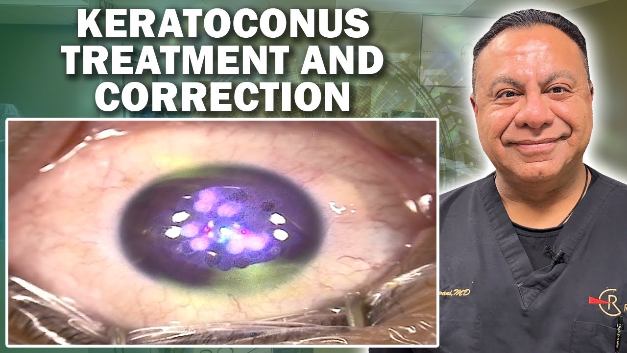 Keratoconus Treatment With the CREATE Protocol - YouTube