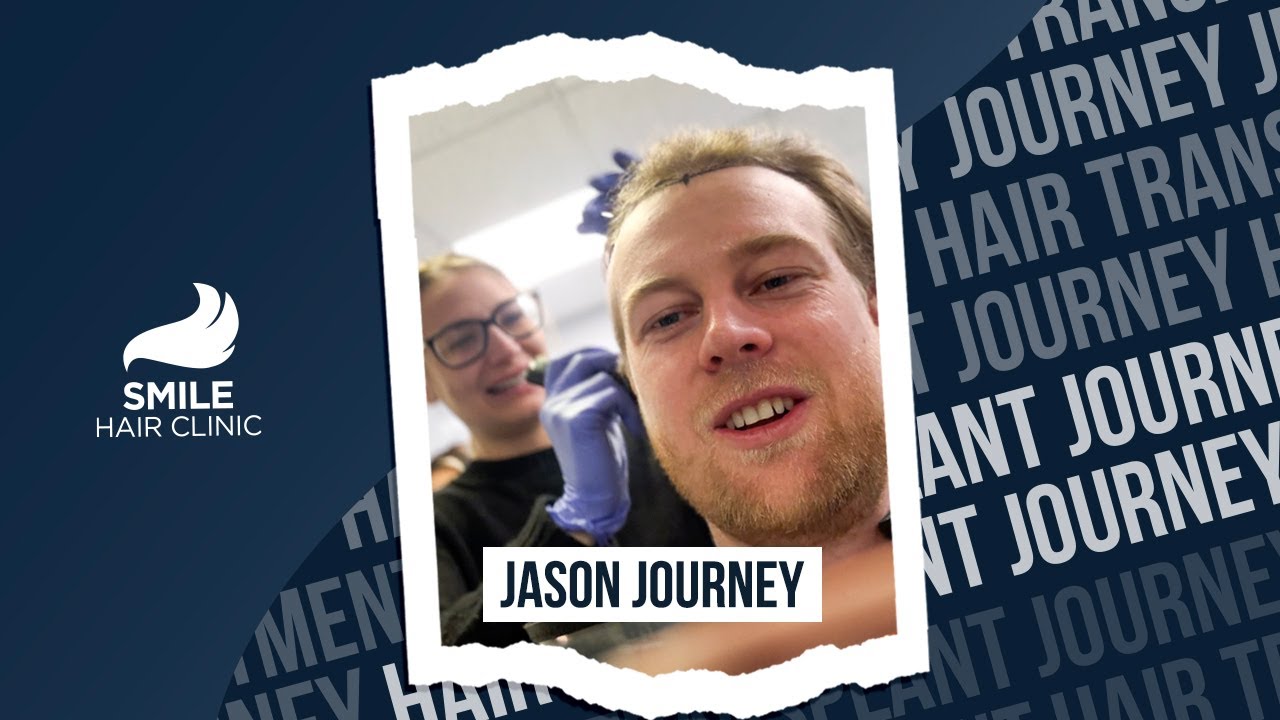 Hair Transplant - Jason’s Hair Journey: Supported by Love | Smile Hair ...