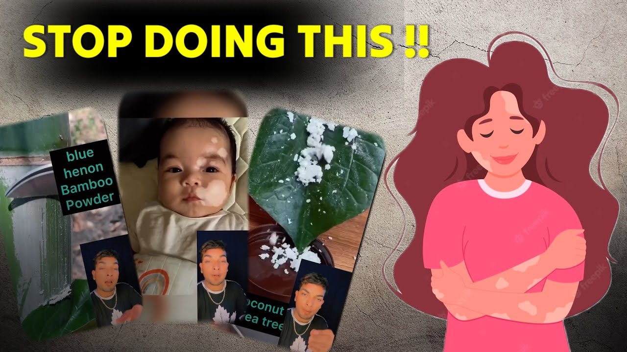 Stop sharing Treatment Reel to us | Aarus foundation | Vitiligo ...