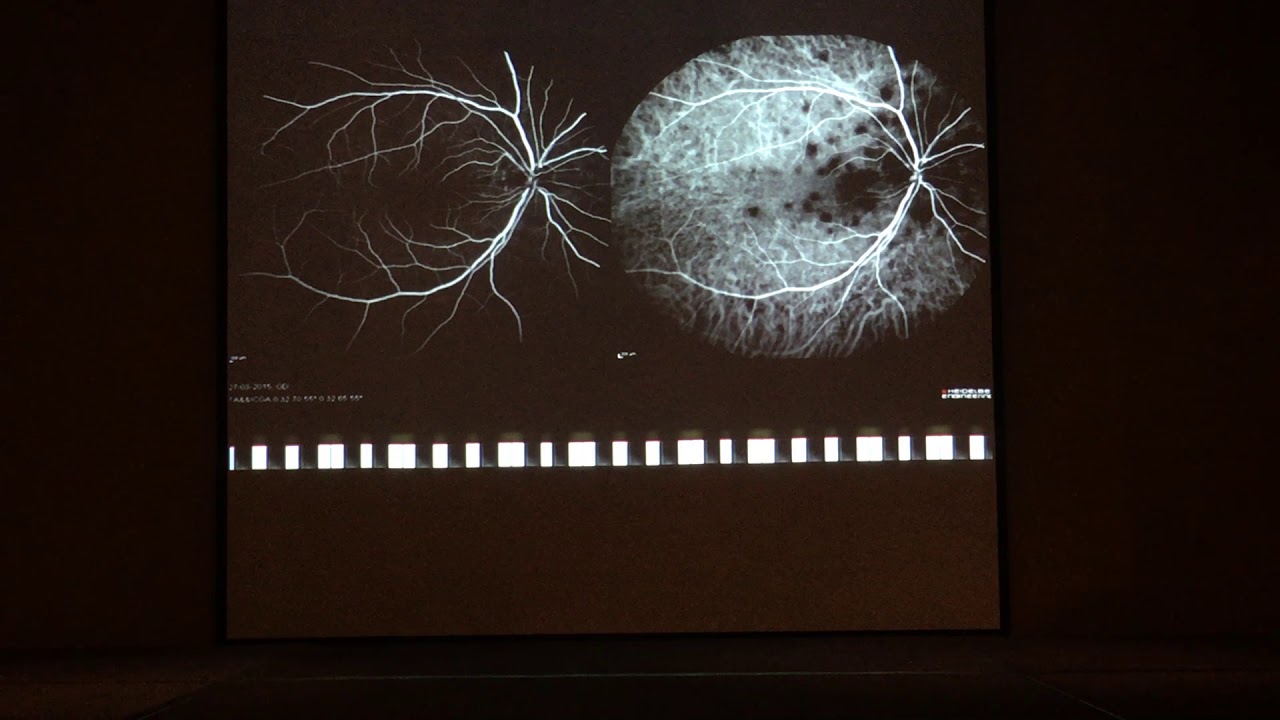 VKH & Sympathetic Ophthalmia Vishali Gupta, India - YouTube