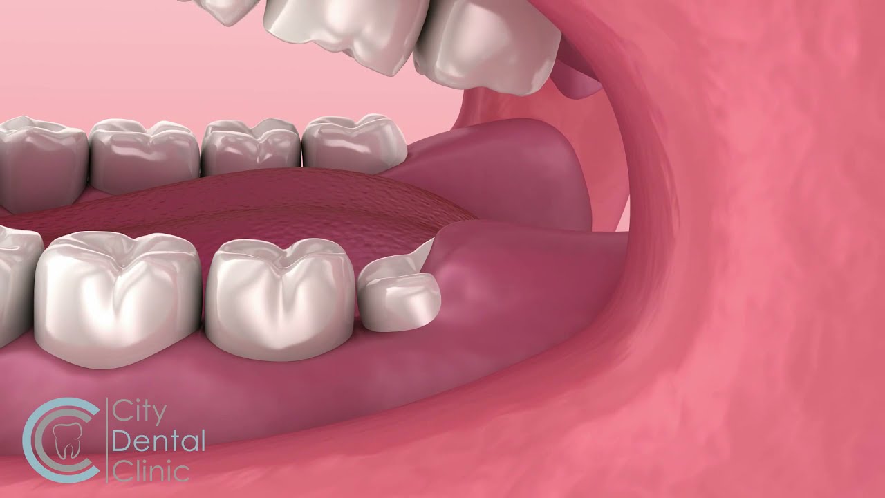 Problem with widsdom teeth - YouTube
