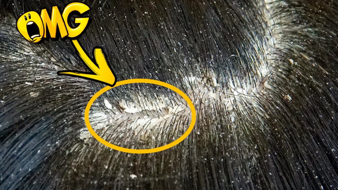 Huge Dandruff Flakes Removal!! Itchy Psoriasis Scalp (Big Flakes) - YouTube