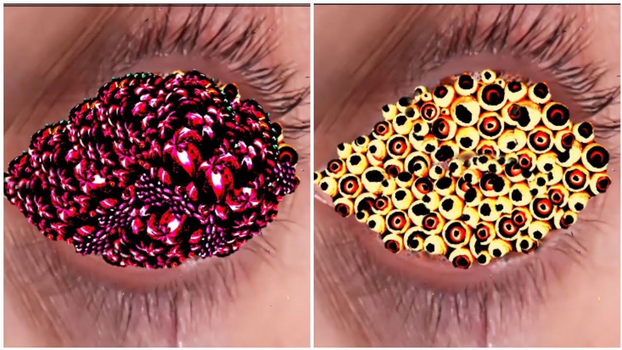 ASMR maggot remove & worm infected of eyes | eyes treatment | ASMR 2d ...
