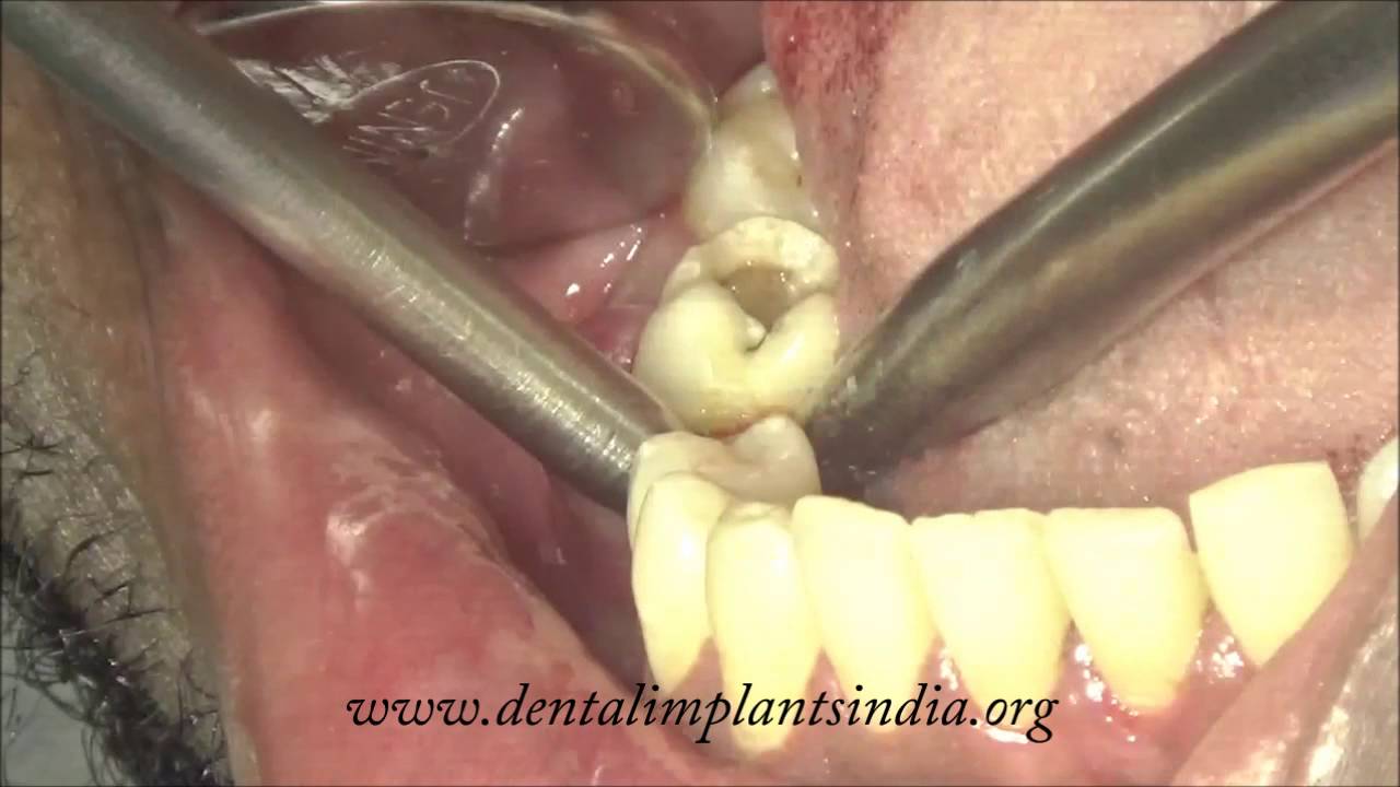 Lingual cortical engagement of basal implants in mandible for first ...