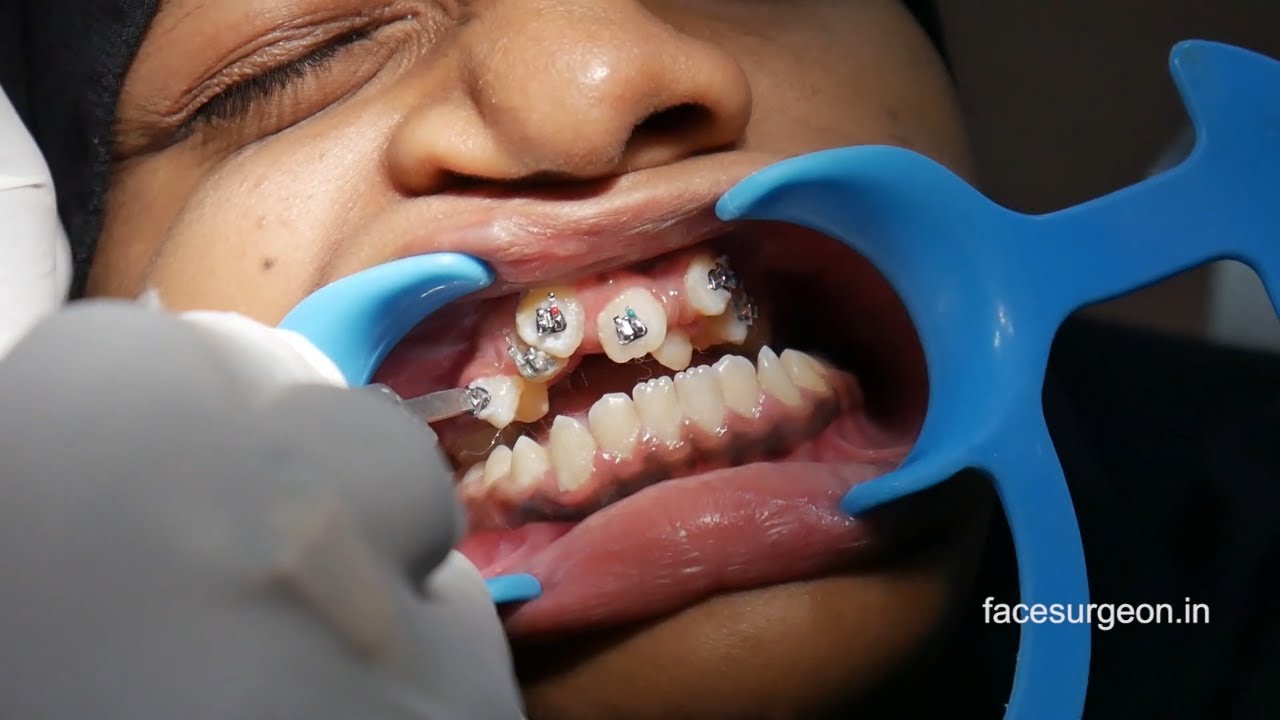 How Braces are put on Teeth | Braces | Orthodontics | Richardsons ...