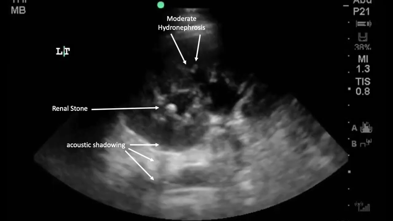 Normal Pediatric Renal Ultrasound Ultrasound Of The Paediatric