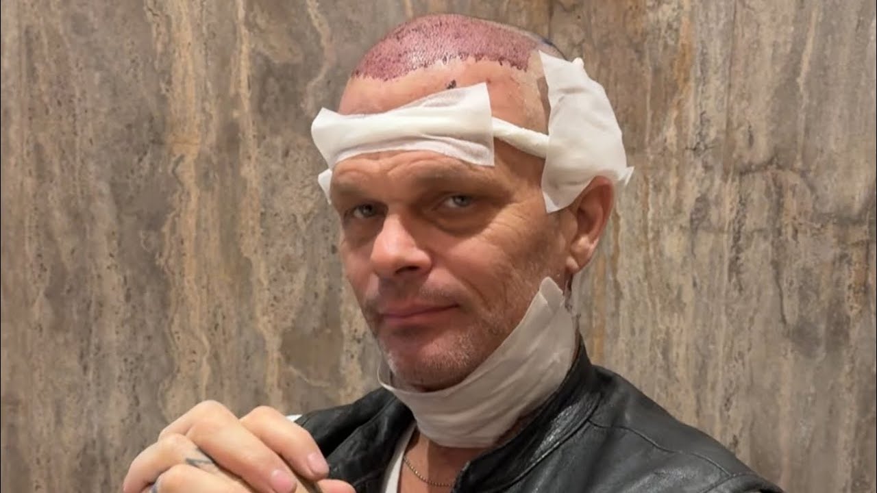 We came to Turkey for Hair Transplant Surgery... Bad Chad gets 5,200 ...