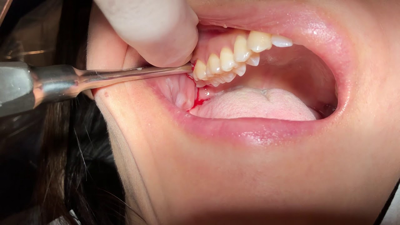 Wisdom tooth extraction - YouTube